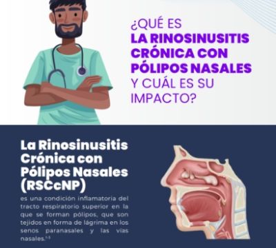 ABC de la Rinosinusitis Crónica con Pólipos Nasales